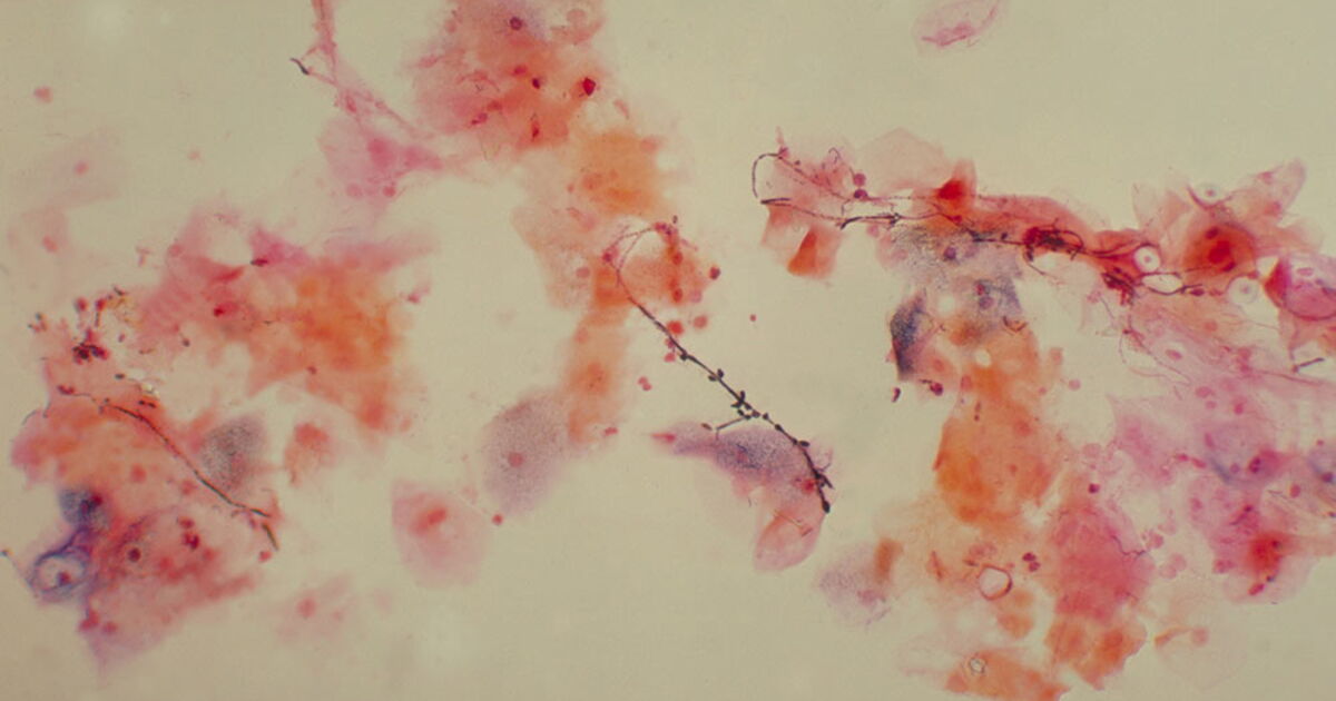 Mycose vaginale : reconnaître les symptômes, adapter le traitement - Ça ...