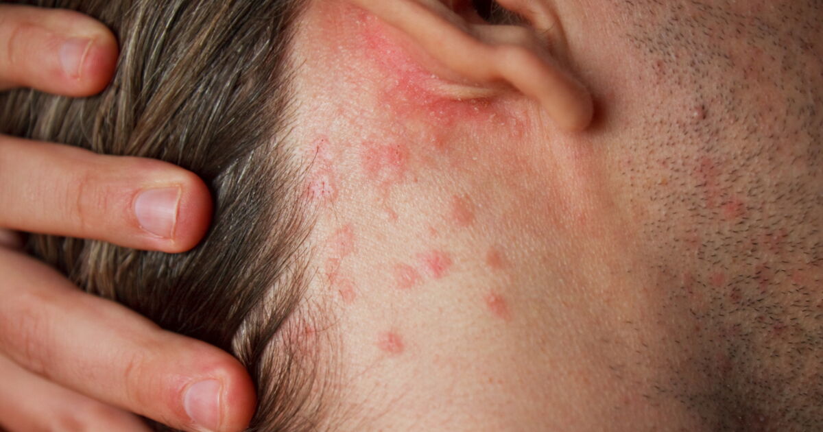 Tout savoir sur le psoriasis : causes, symptômes, traitement ...