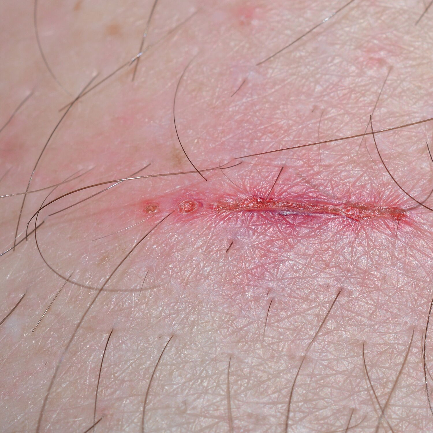 Que mettre sur une brûlure avec cloque percée ? - Caminteresse.fr